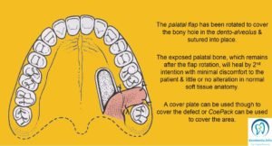 Palatal Flaps – Exodontia
