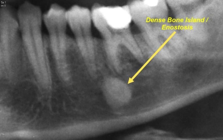 Dense Bone Islands – Exodontia