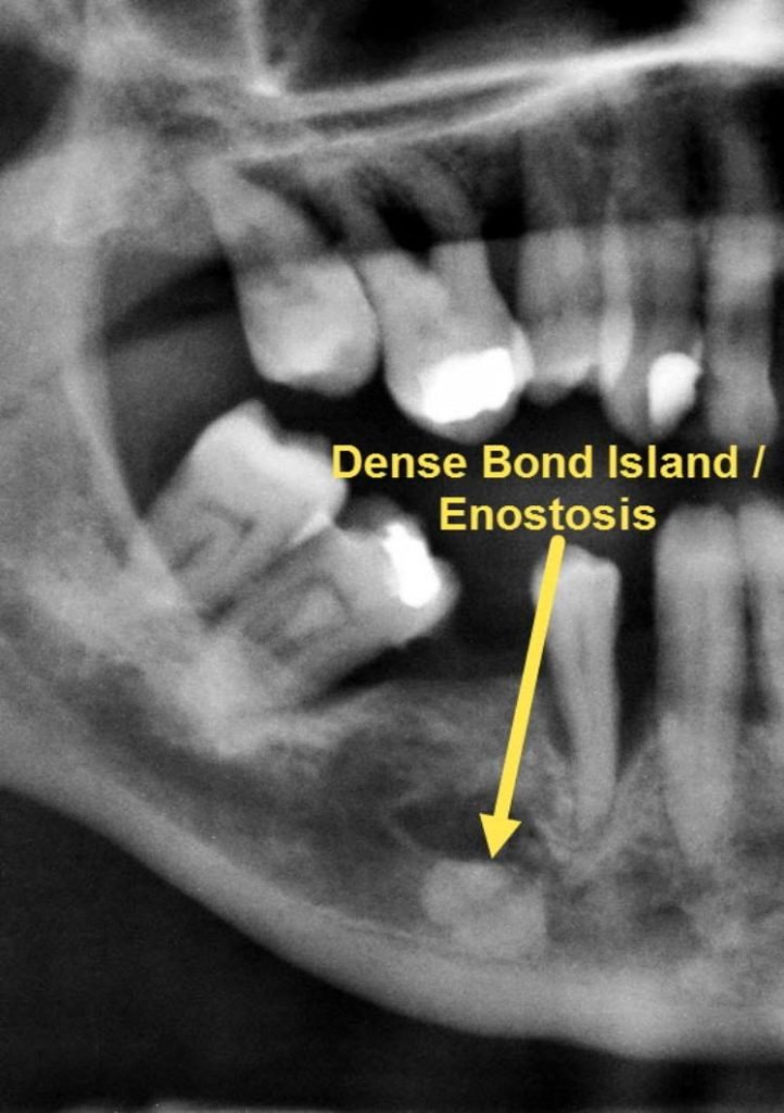 Dense Bone Islands – Exodontia