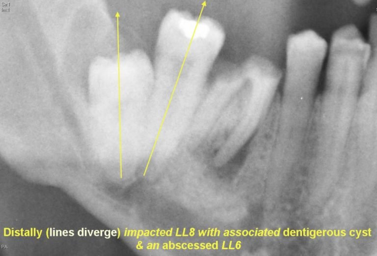 Impaction Classification – Exodontia