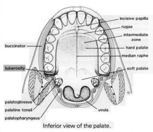 Fractured Maxillary Tuberosity – Exodontia