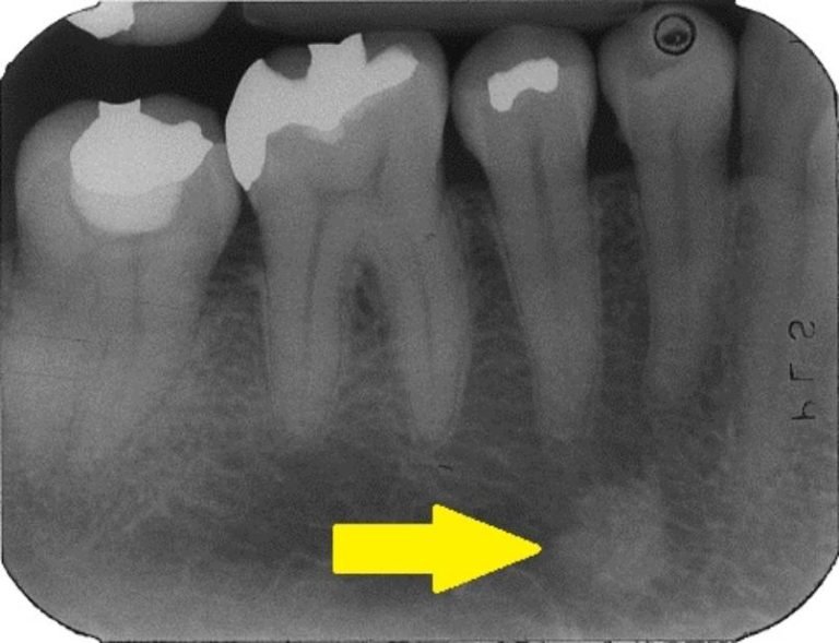 Dense Bone Islands – Exodontia