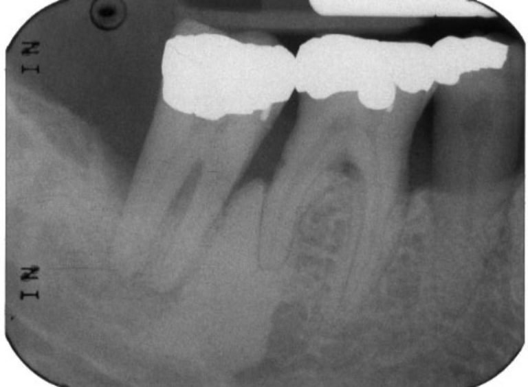 Dense Bone Islands – Exodontia