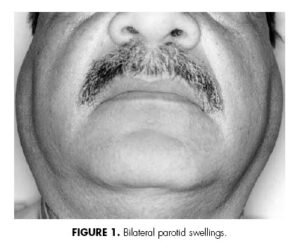 Sialosis / Sialadenosis – Exodontia