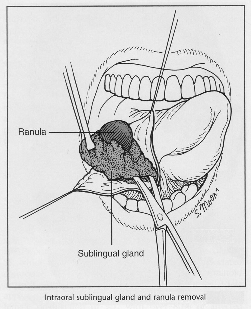 Ranulas / Ranulæ & Their Treatment – Exodontia